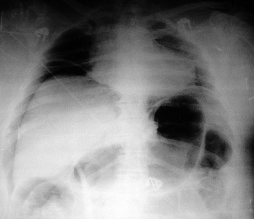 Signos Radiologicos Del Neumoperitoneo