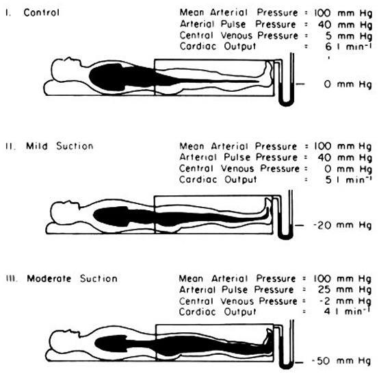 Volumen sanguíneo: su distribución y relación con la precarga ...