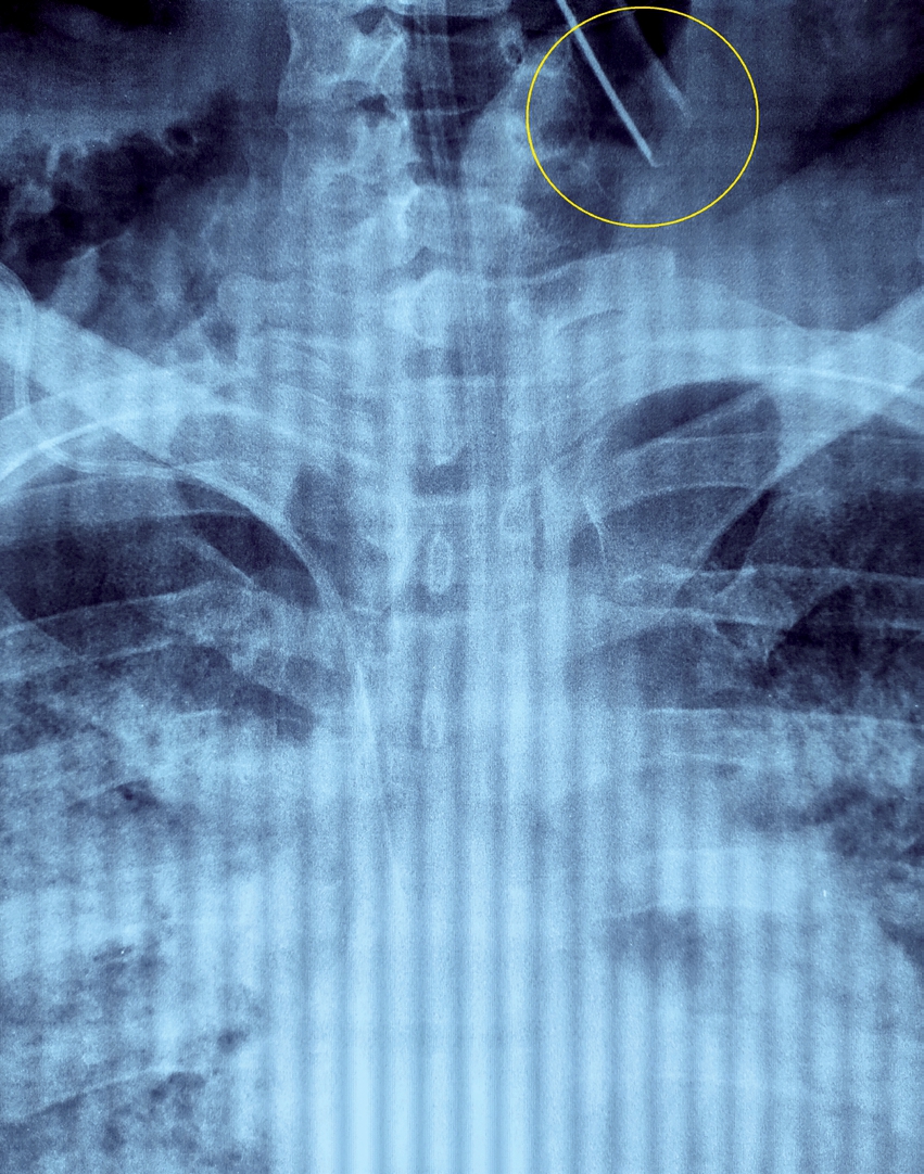 Lesión traqueal como hallazgo radiológico. A propósito de un caso ...