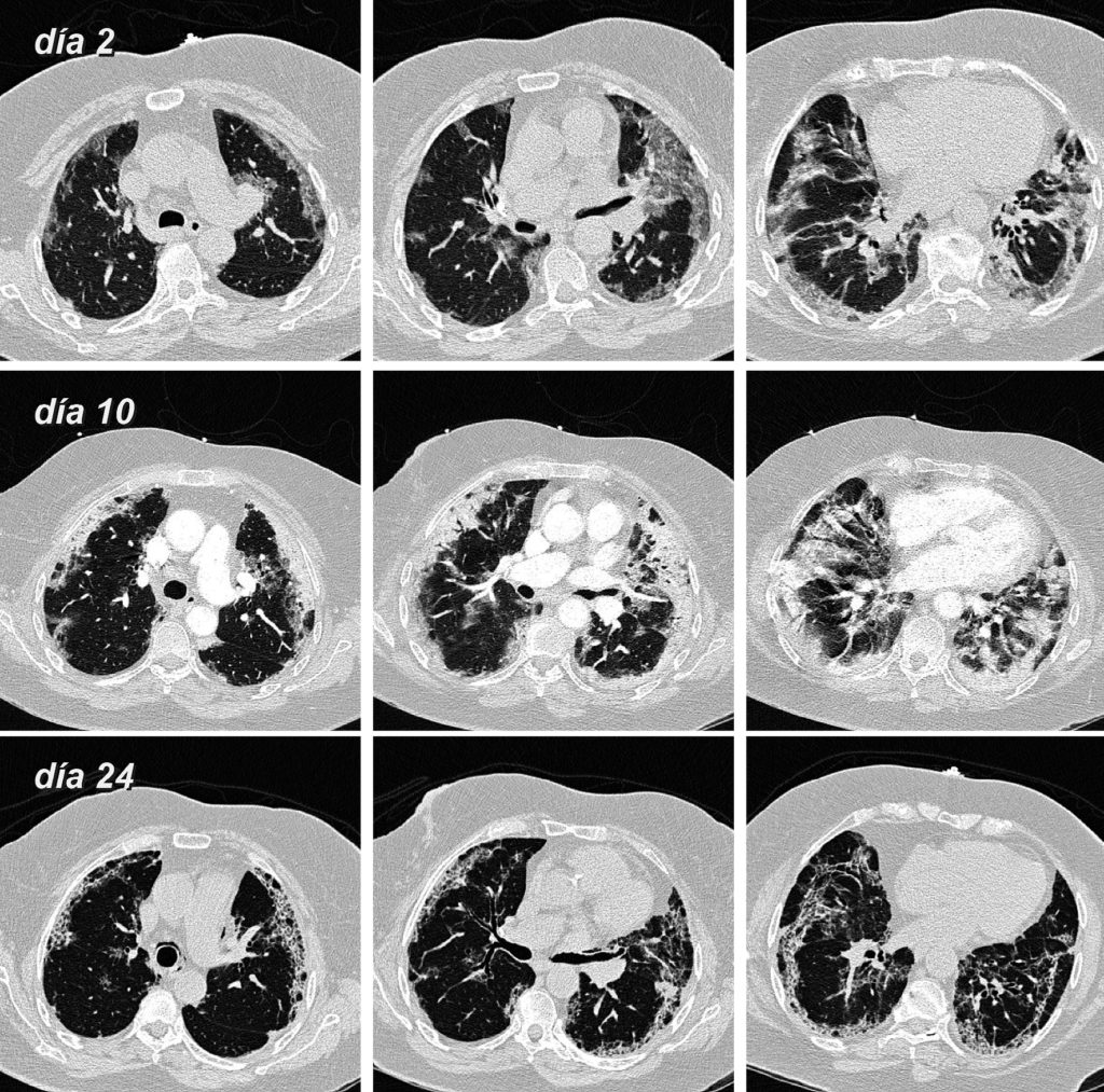 Soporte ventilatorio en pacientes críticos con COVID-19:a 18 meses de ...