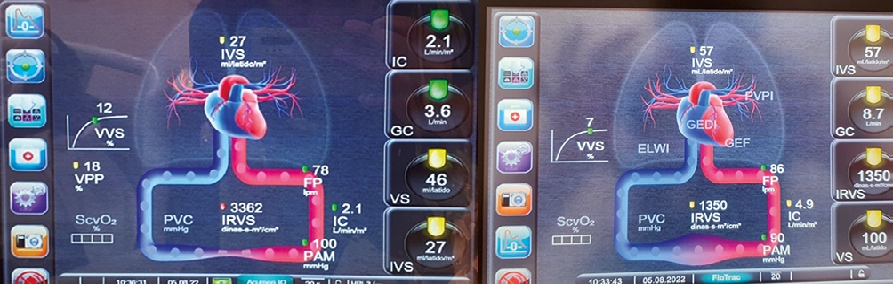 Inestabilidad hemodinámica en obstetricia - Revista Chilena de Anestesia