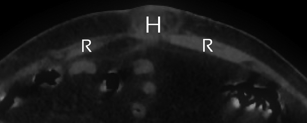 Bilateral rectus sheath block as the sole anesthetic technique for ...