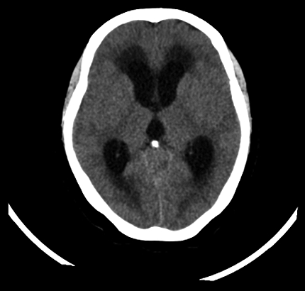 Manejo anestésico en una paciente embarazada con meduloblastoma de fosa ...