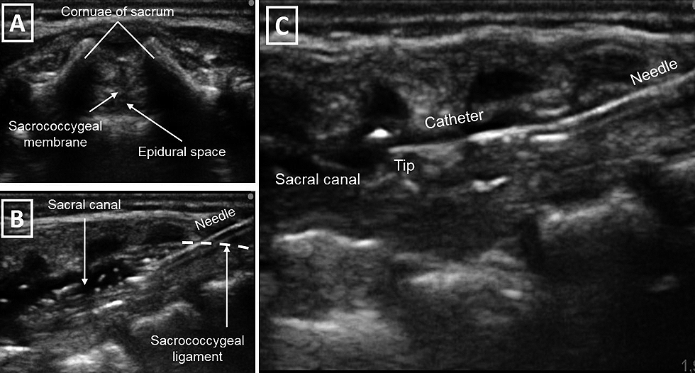 Anesthetic management with ultrasound-guided caudal epidural catheter ...